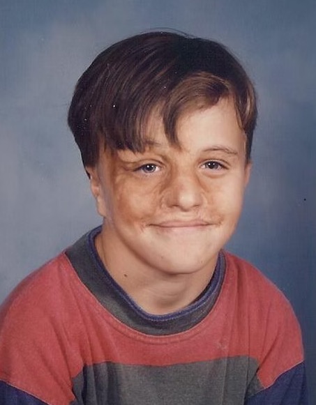 From Burn Victim to Survivor: The Unbreakable Spirit of Keith Edmonds